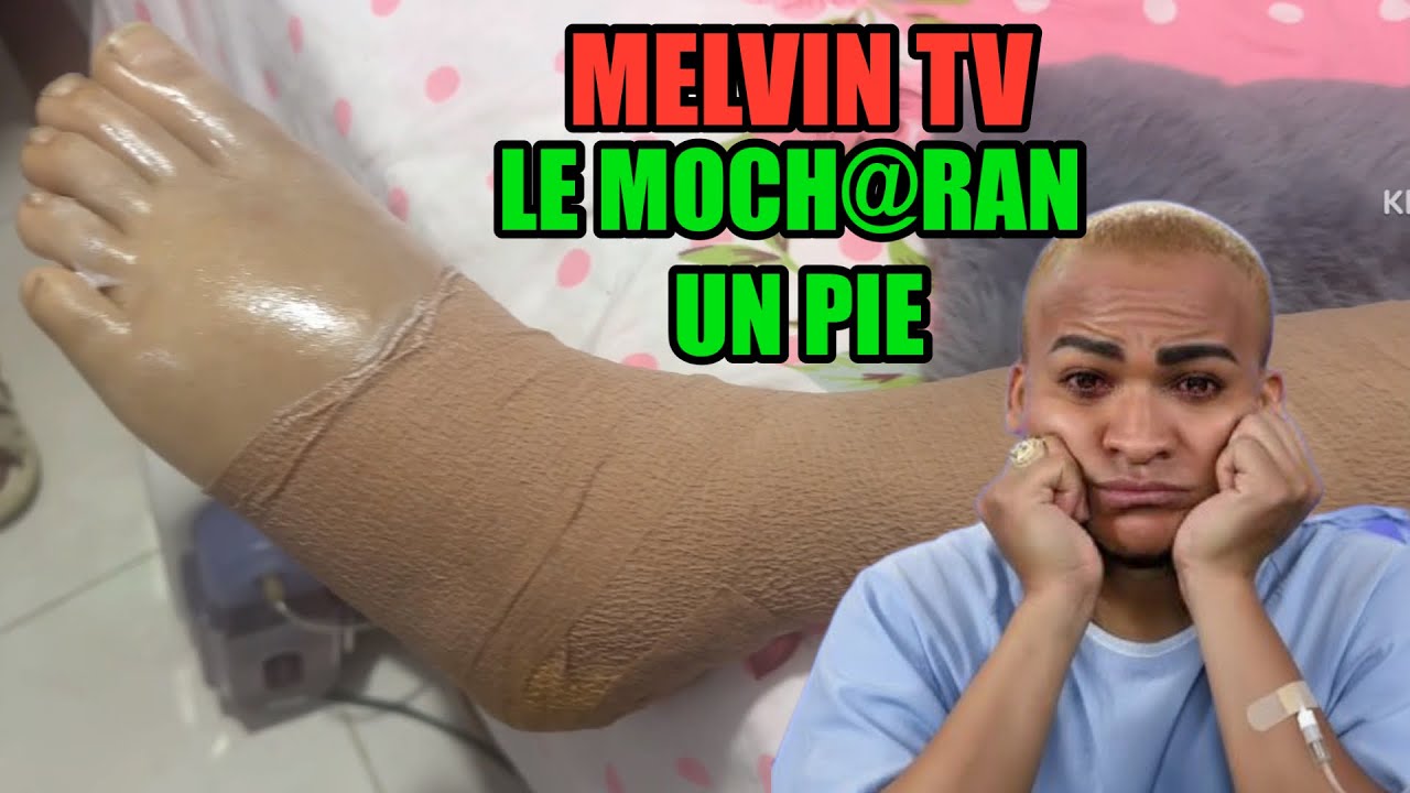 MELVIN TV PERDERÁ UN PIE - YouTube