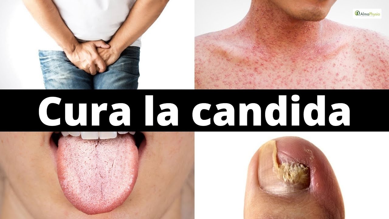 Elimina la candida in modo naturale - YouTube