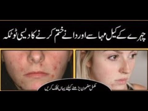 Keel Mahasay aur Daane Acne and Pimples Kay Elaj Ka Totkay