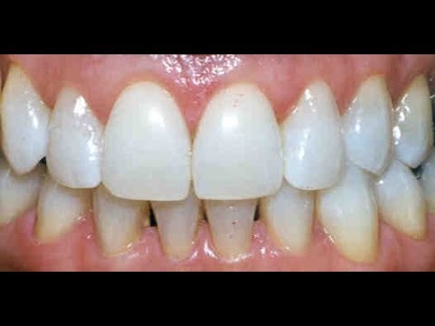 How to whiten your teeth at home using strips by Stella White