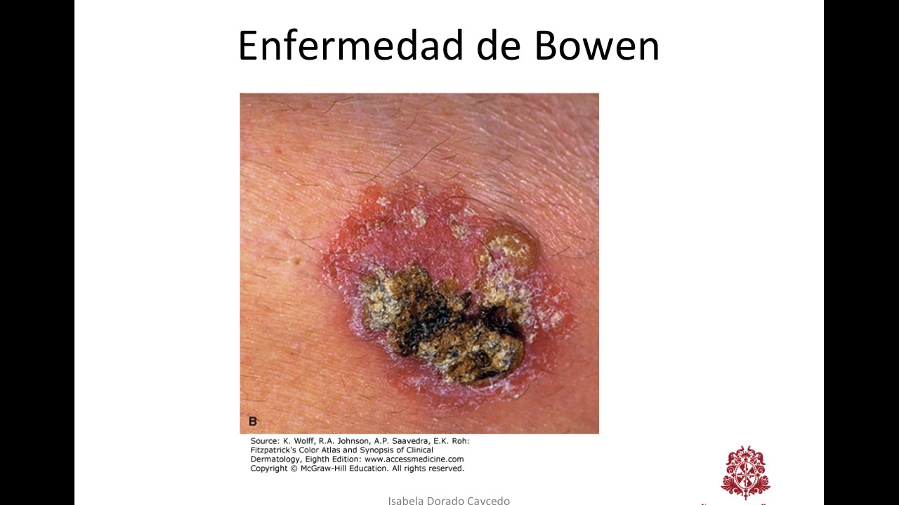 Neoplasias Malignas Carcinoma Escamocelular - YouTube