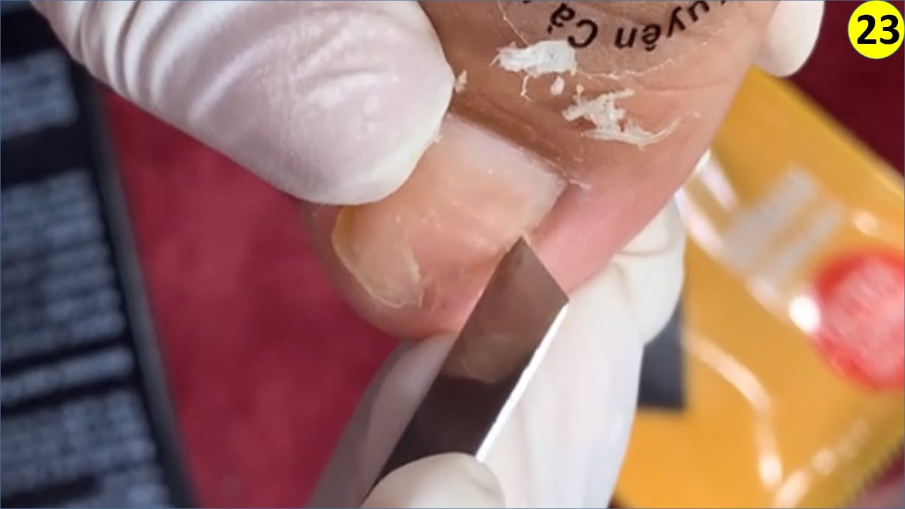 How to Repair Toenail || Remove Dead Skin #23 - YouTube