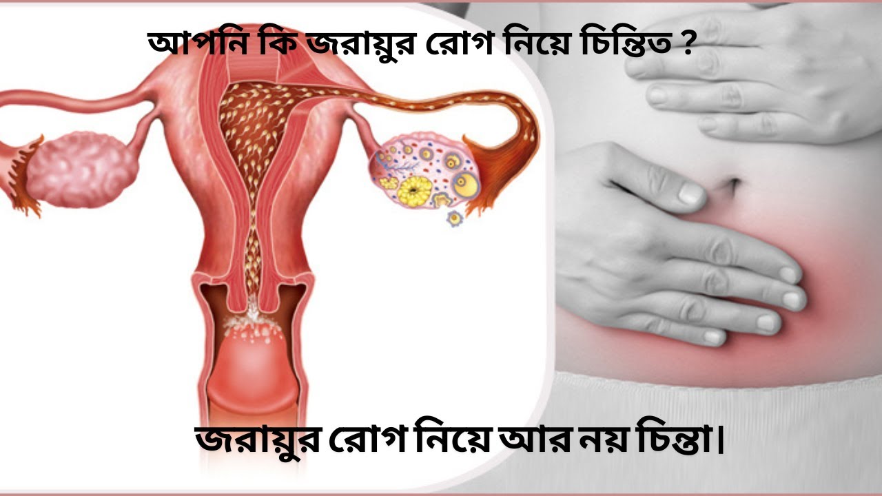 মেয়েদের জরায়ুর সকল রোগের ১০০% সহজ এবং সাফল্যময় চিকিৎসা নিয়ে এলো AYUSH PHARMA BD. - YouTube