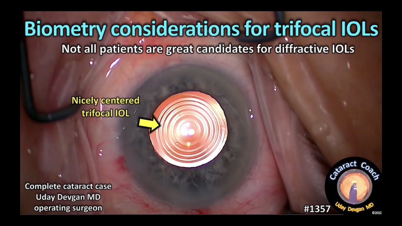 CataractCoach 1357: biometry considerations for trifocal IOLs - YouTube