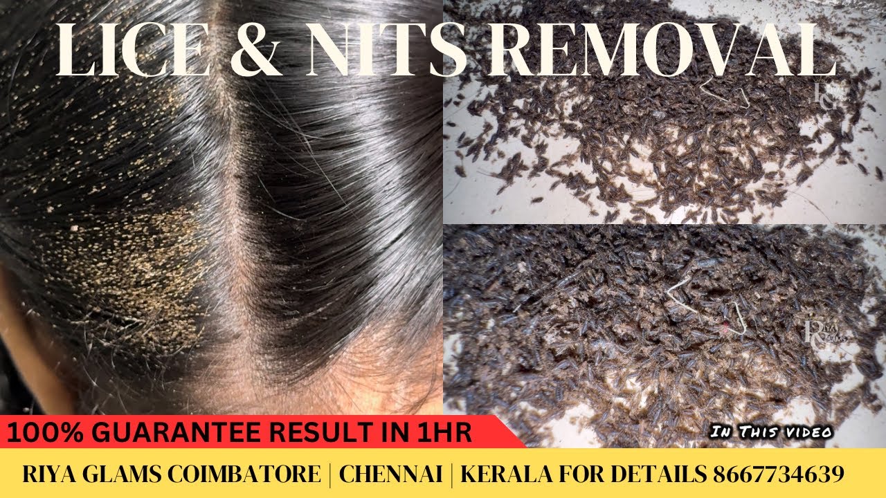 How to remove Lice from Hair/how to remove Lice permanently/how to ...