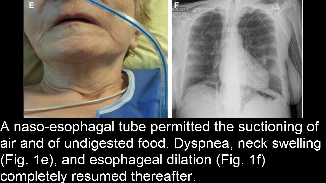 Dyspnoe bei dilatiertem Ösophagus - YouTube