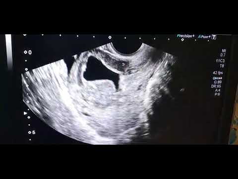 Failed Pregnancy with chorionic bump - YouTube