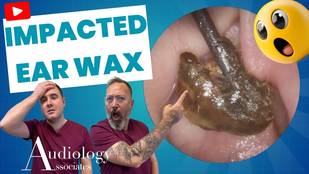 HOOKING Out MASSIVE Impacted Ear Wax Plugs! 😱 Audiologists Explain the ...