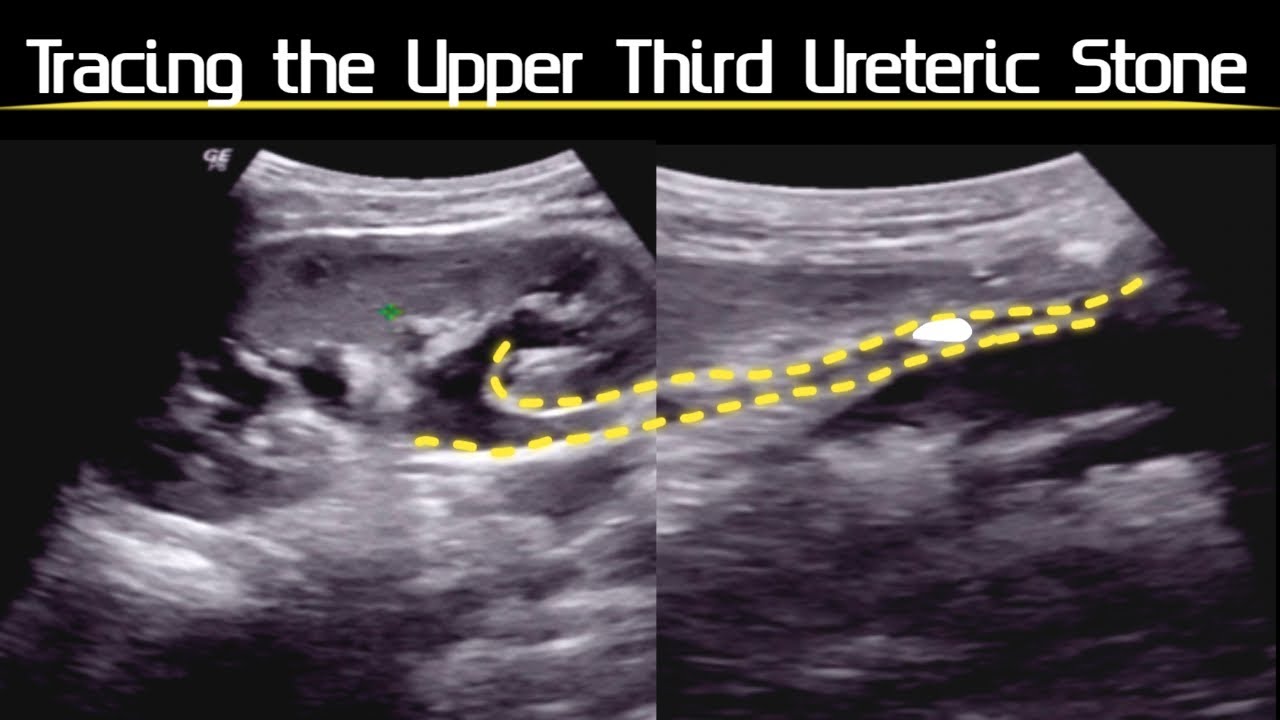 Tracing The Upper Third Ureteric stone - YouTube