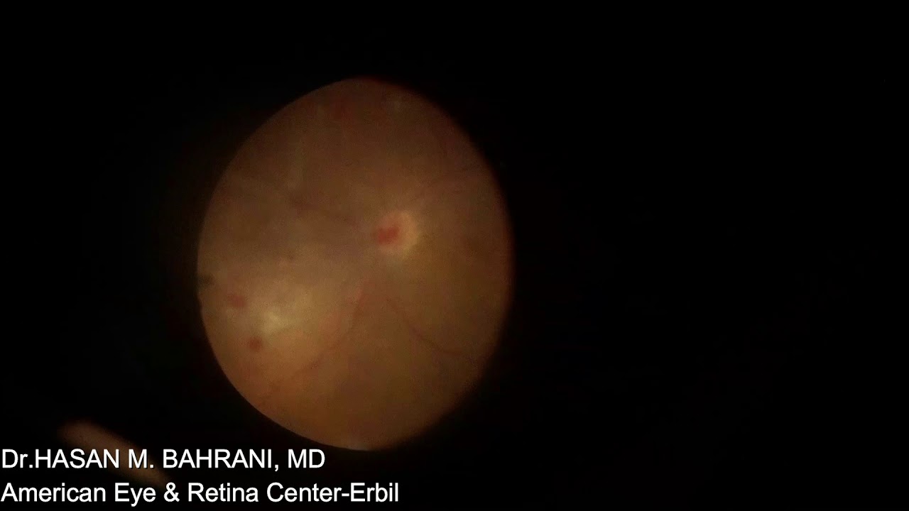 Vitrectomy for PDR VH Membrane Peeling. Dr Hasan M Bahrani,MD - YouTube