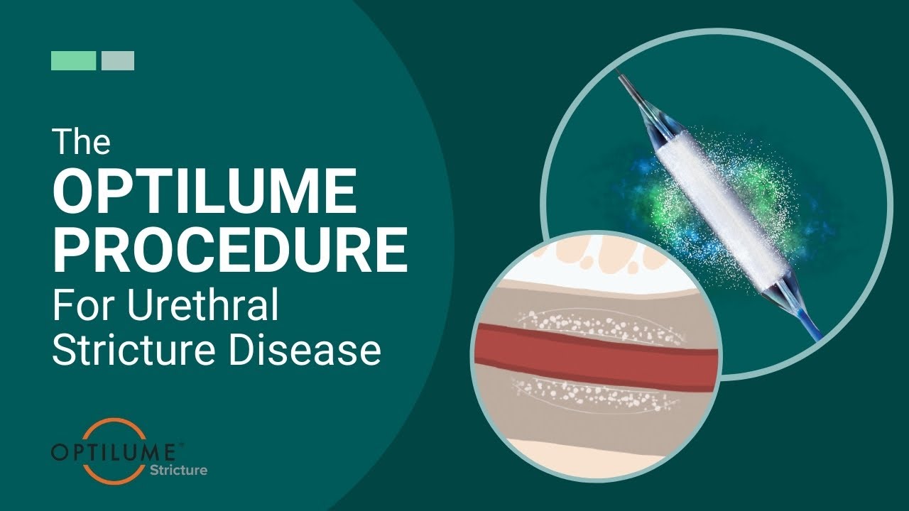 The Optilume Procedure For Urethral Stricture Disease - YouTube