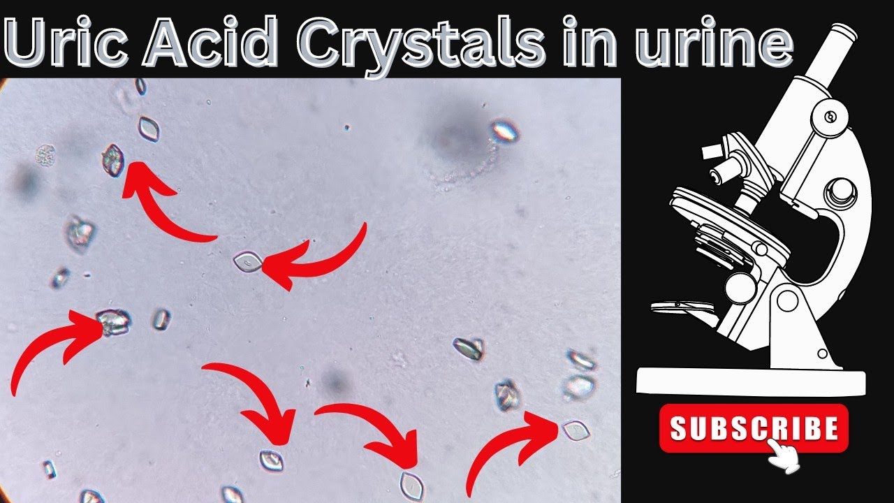 Uric acid crystals in urine | Crystals under microscope ...