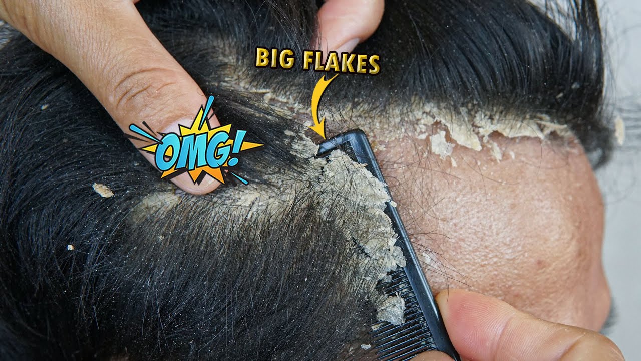 Itchy Dry Scalp Big Dandruff Flakes Scratching #1177 - YouTube
