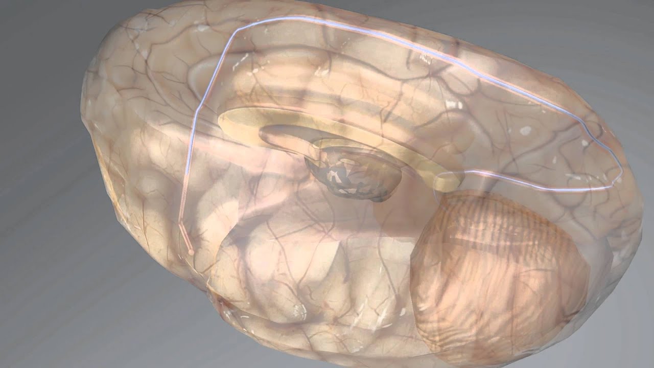 Animation - Stentrode and brain catheter - YouTube
