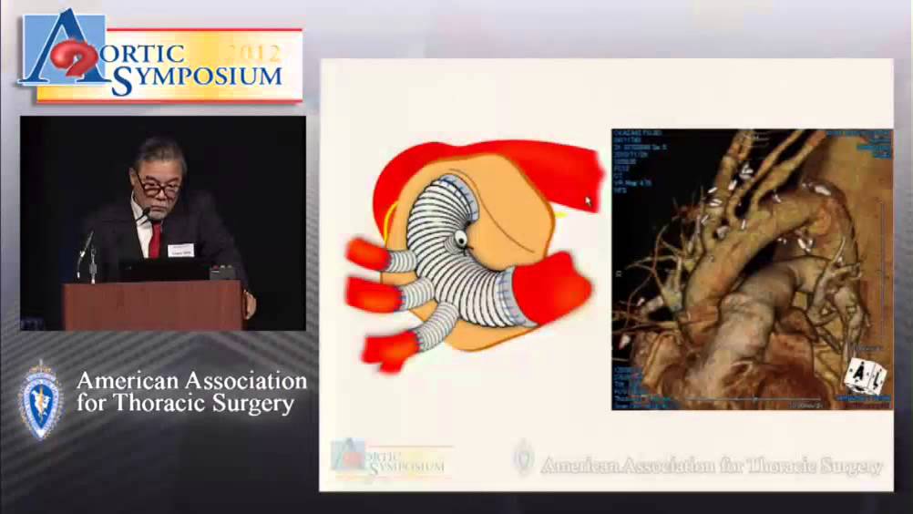 Total Aortic Arch Replacement Using 4 Branch Graft - YouTube