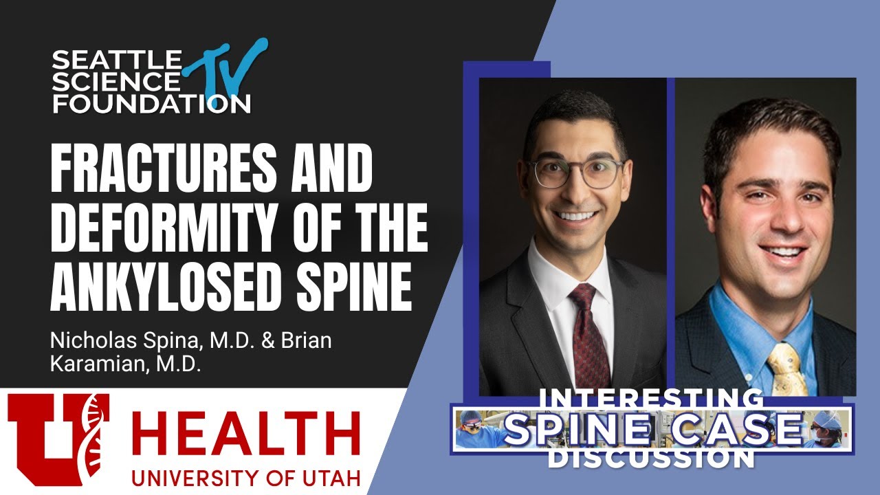 Fractures and Deformity of the Ankylosed Spine - Nicholas Spina, MD ...