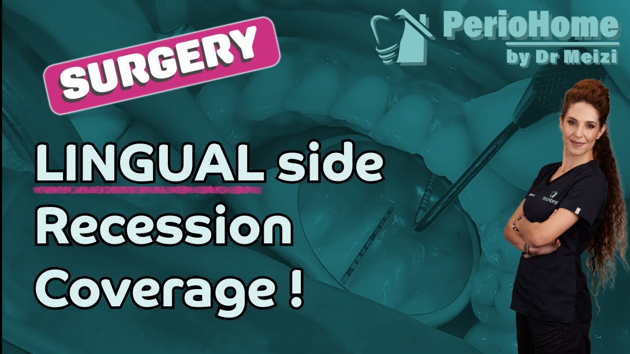Lingual Side Recession Coverage - YouTube