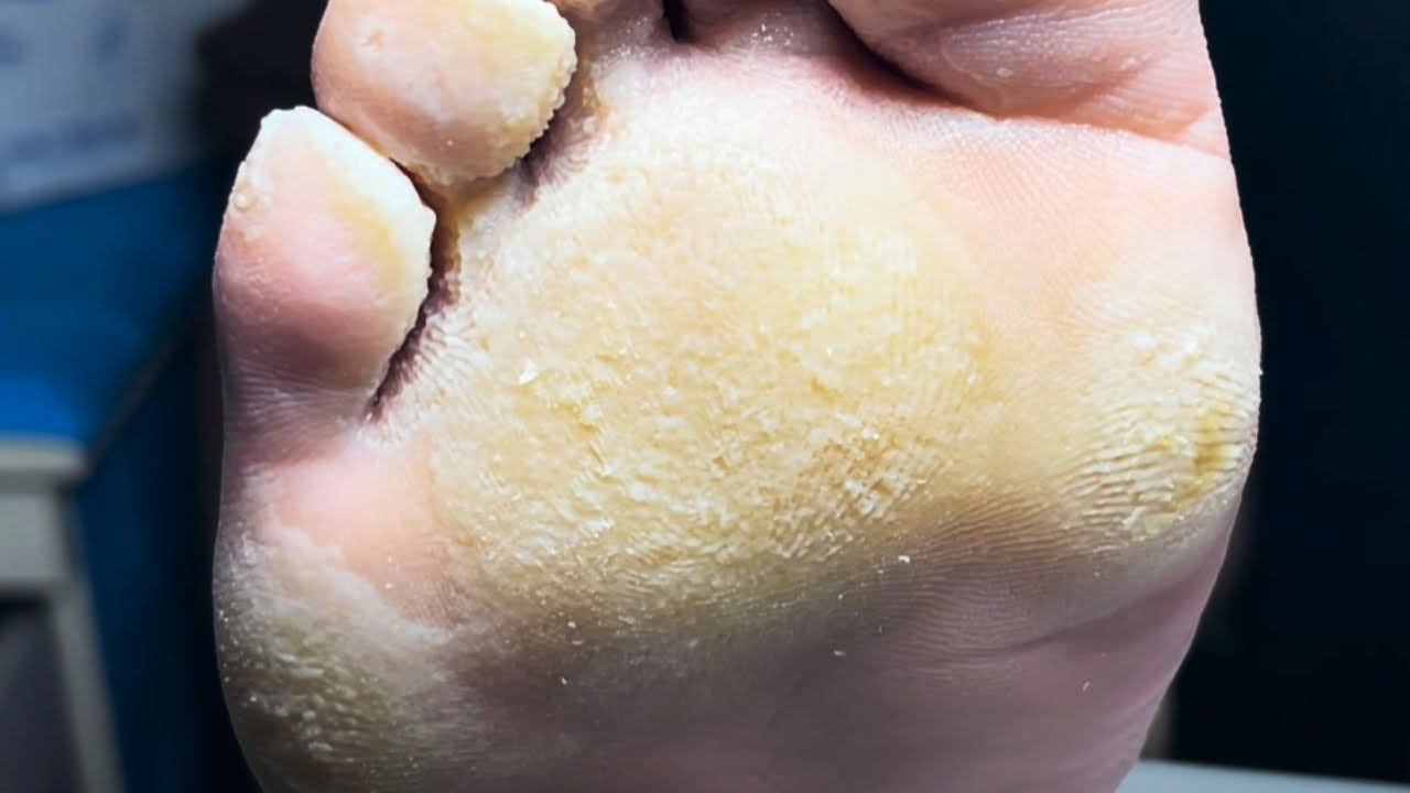 Perfect For Cleaning Yellow Calluses On The Soles Of Feet!【Pedicure ...