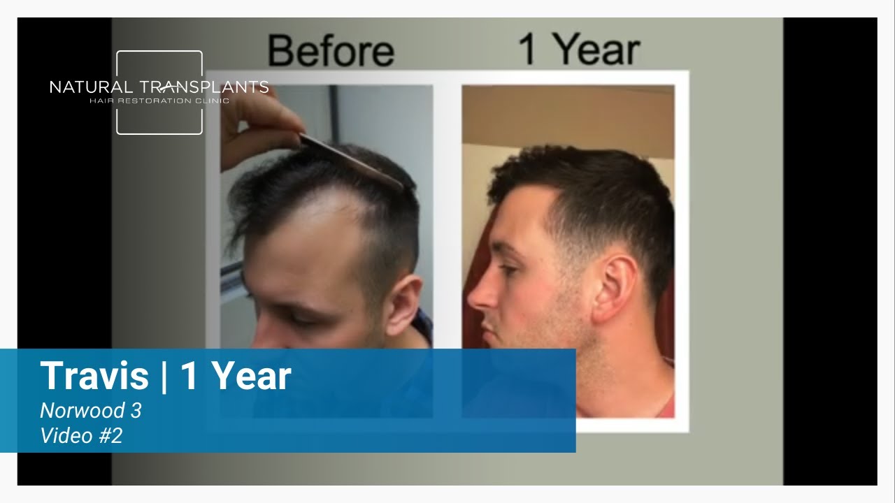 Stronger Hairline, Stronger Confidence: 1-Year Hair Transplant Progress | Dr. Blumenthal (Travis ...