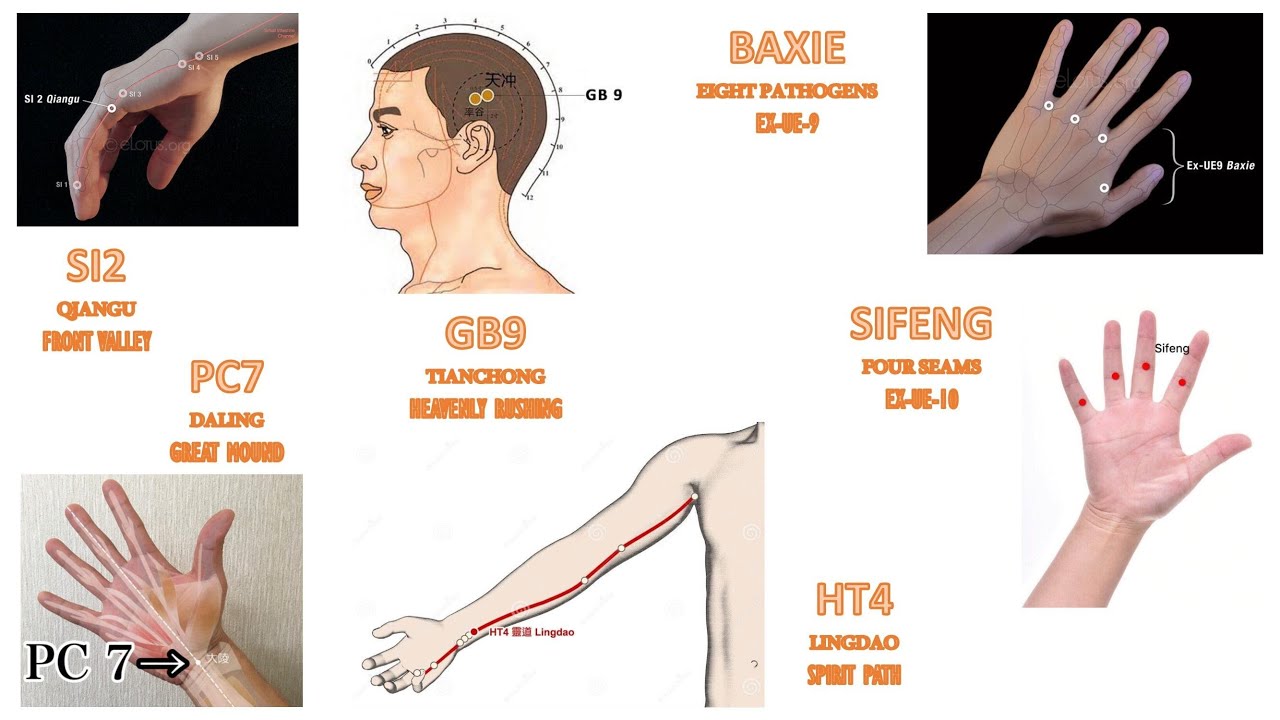 LAMP ACUPUNCTURE 30: SI2 Qiangu, PC7 Daling, Baxie, Sifeng, HT4 Lingdao ...