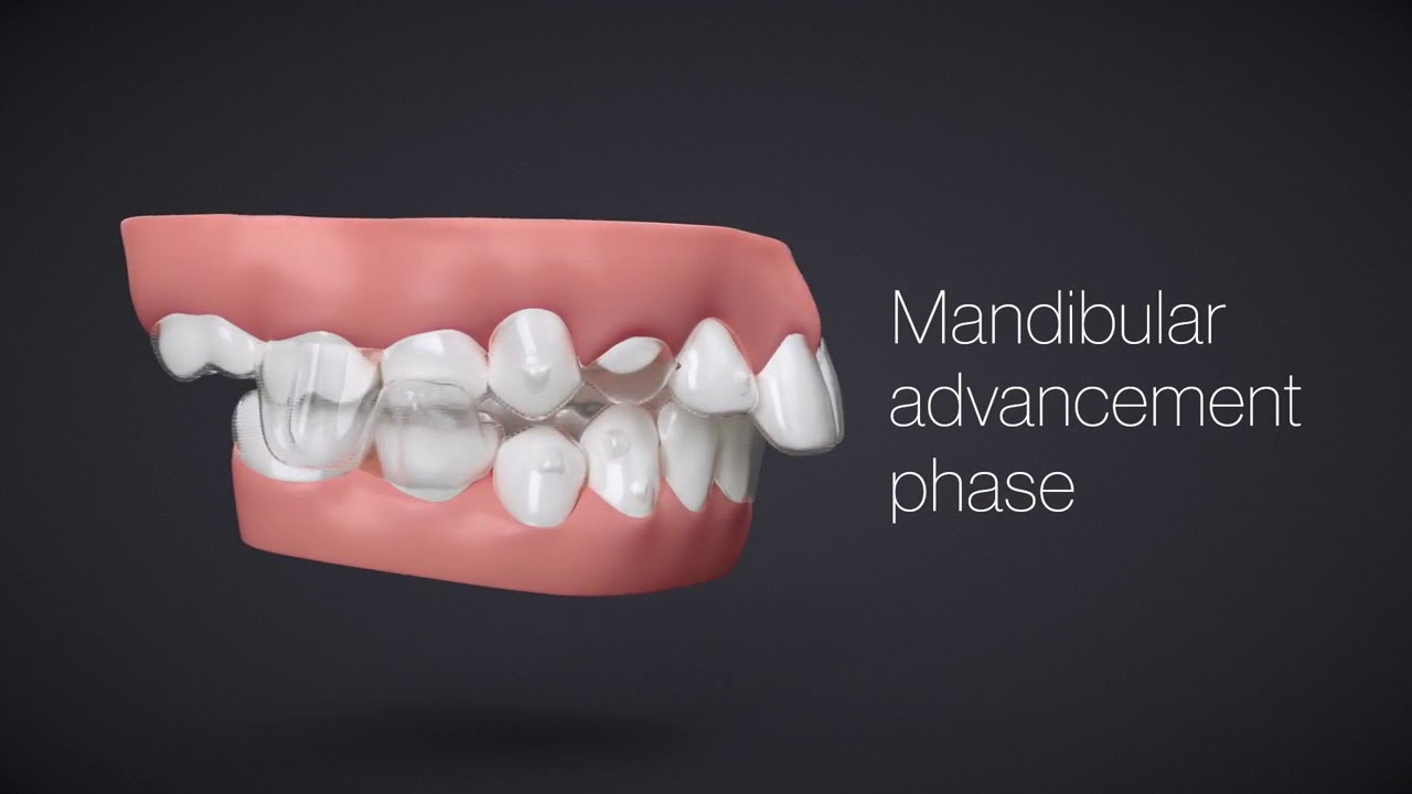 InvisalignÂ® Treatment with Mandibular Advancement How It Works - YouTube