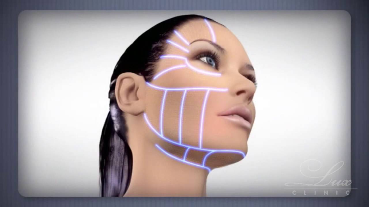 Безоперационная подтяжка лица (Альтера Систем/Ulthera System) Люкс ...