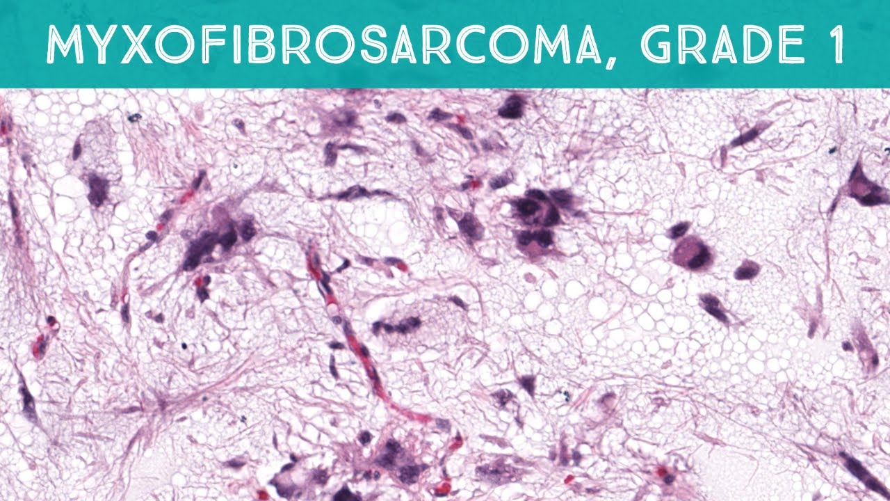 Myxofibrosarcoma, grade 1/low grade (explained in 5 minutes) dermpath ...
