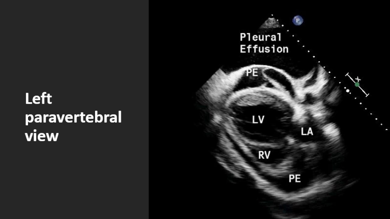 Massive pericardial effusion& pleural effusion in left para-vertebral ...