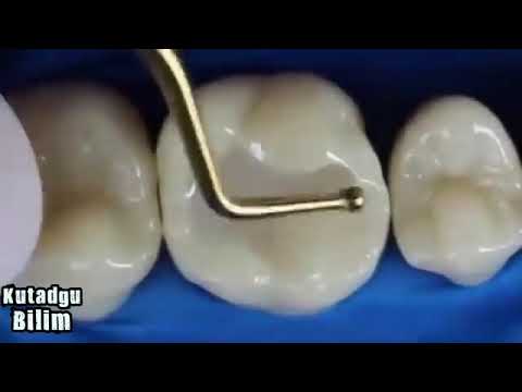 Dental kompozit reçine ile dişteki büyük bir deliğin kusursuz bir şekilde doldurulma işlemi.
