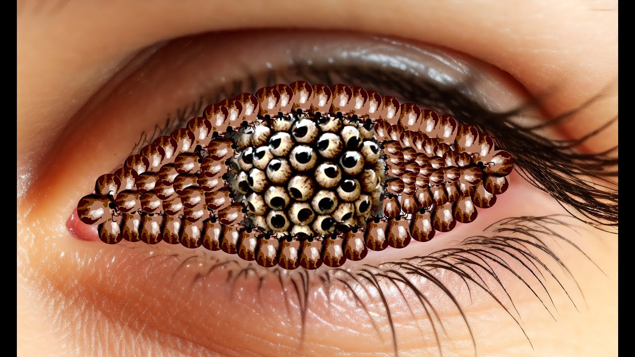 ASMR Remove dog tick , Maggot , spider , lice , from infected eye | ASMR Animation treatment ...