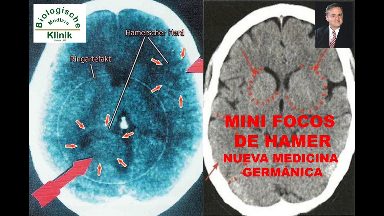 Mini Focos de Hamer. NMG. Dr Jorge Coutiño Hdz - YouTube