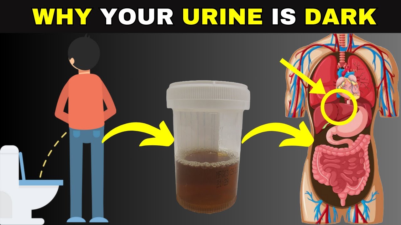 The Truth Behind Dark Urine and When to Worry | Urine Color - YouTube