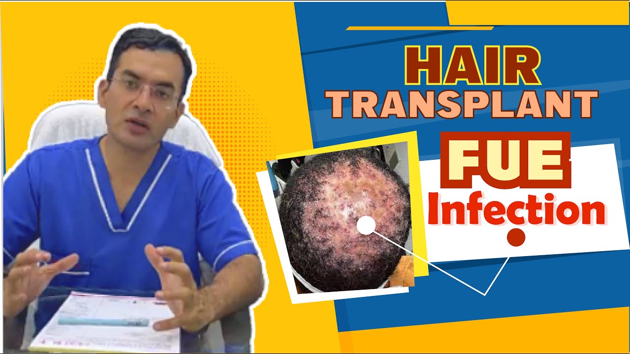 Infection in FUE Hair Transplant | Complications in Hair Transplant ...