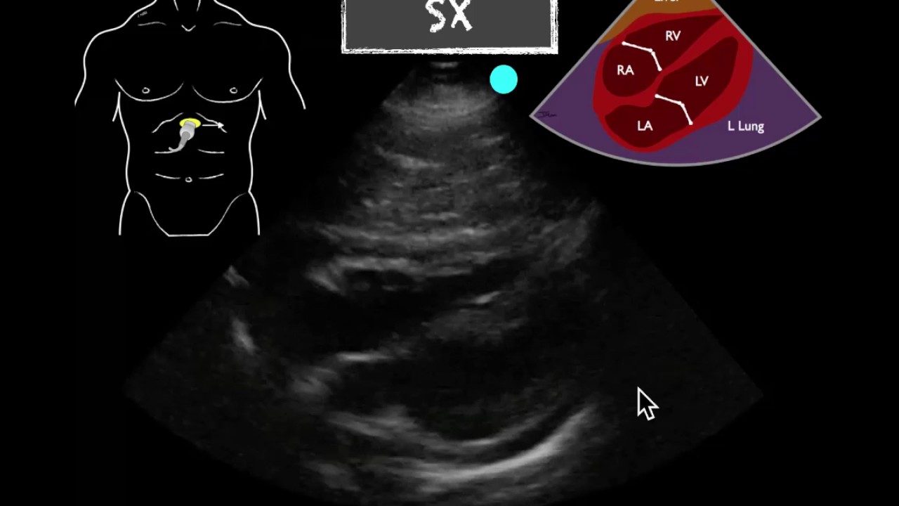 POCUS Teaching Point Pericardial effusion - YouTube