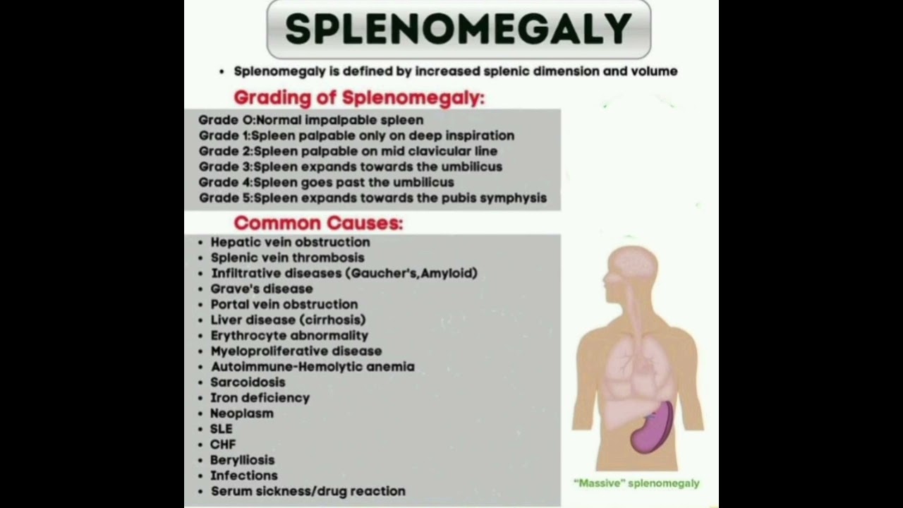 👒 Splenomegaly 👒 - YouTube
