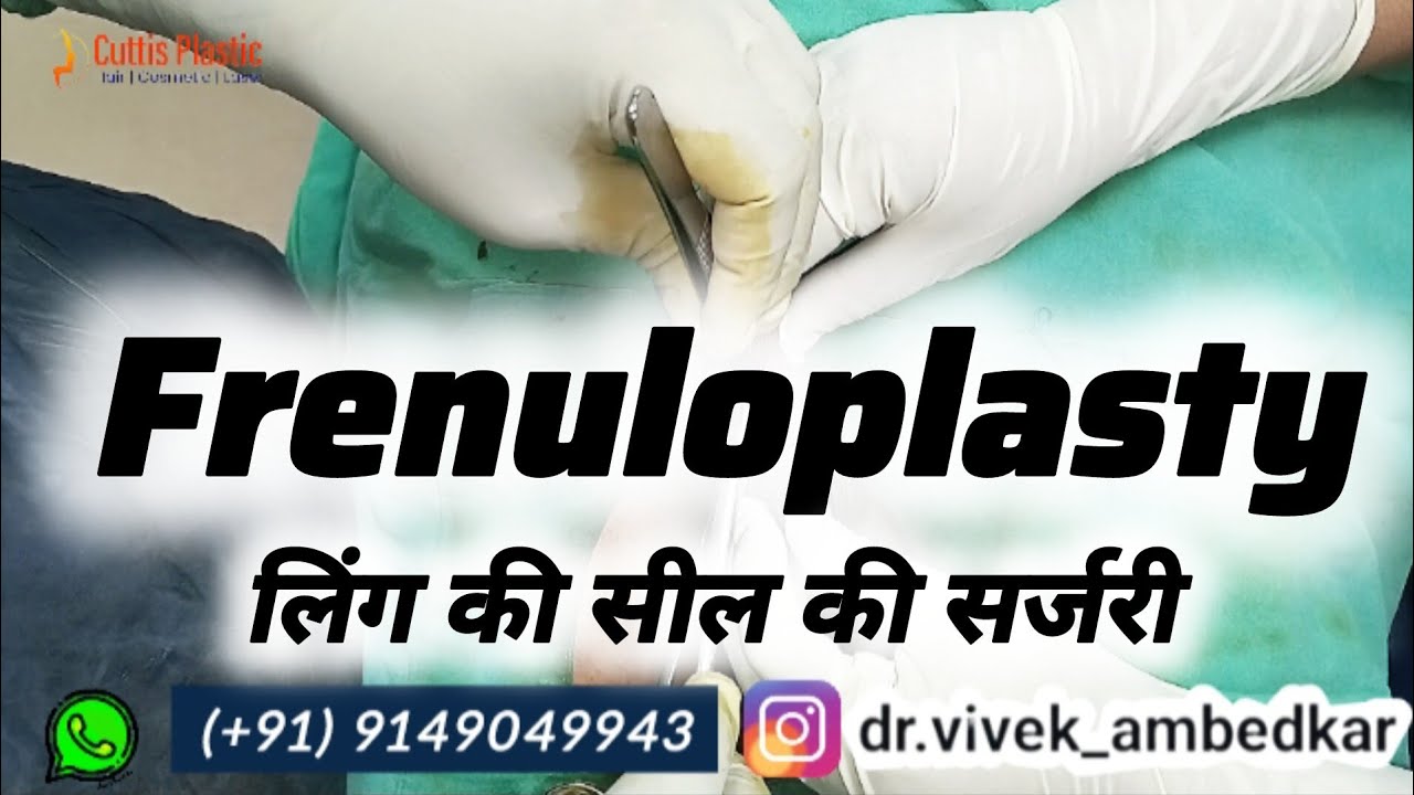 Frenuloplasty | Tight Frenulum | Ling ki Seal Ki Surgery - YouTube