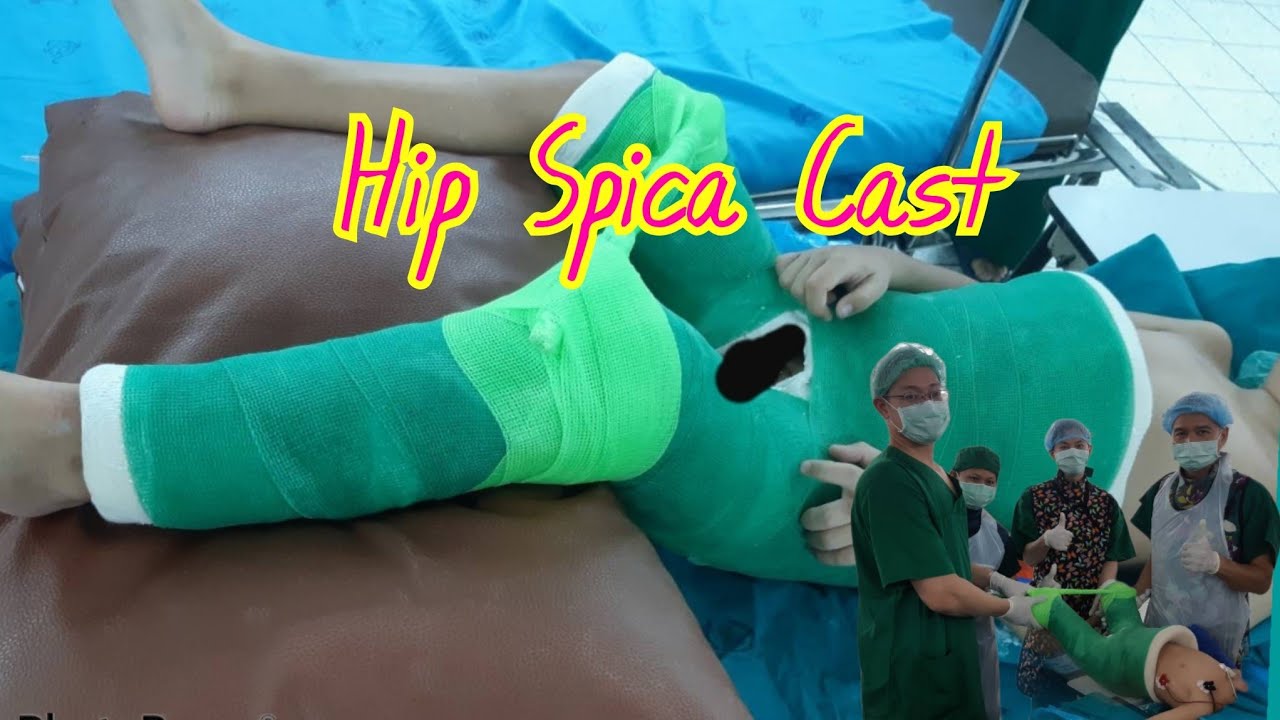 Hip Spica Cast