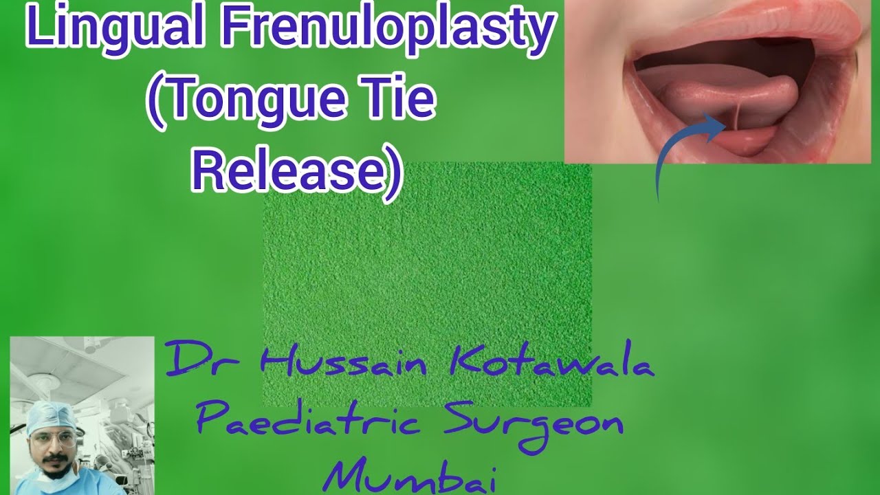 Lingual Frenuloplasty (Tongue Tie Release) for Ankyloglossia - YouTube