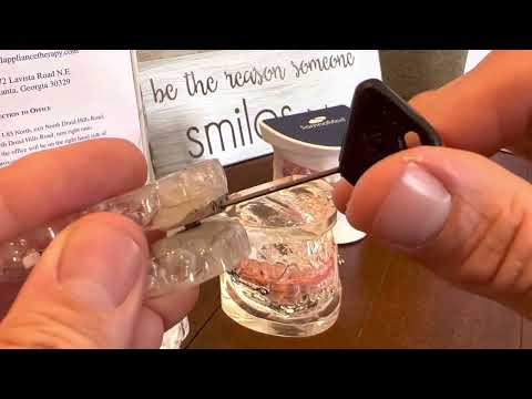 Advancing a TAP device. Oral appliance therapy for sleep apnea. - YouTube