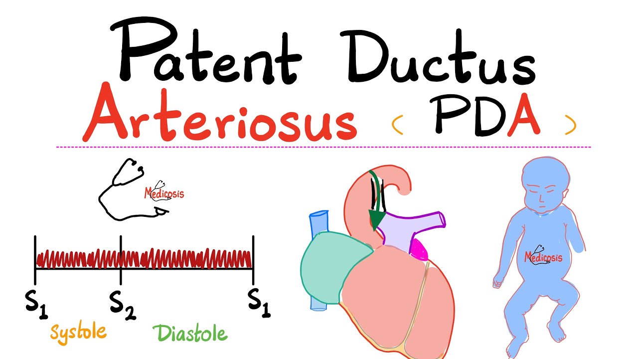 Patent Ductus Arteriosus (PDA) - Acyanotic Congenital Heart Diseases ...