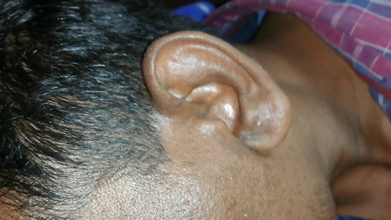 Pus popping from ear labule - YouTube