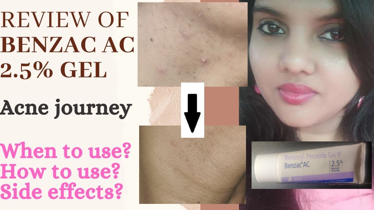 Benzoyl Peroxide For Acne Pimples Whiteheads Blackheads Acne Scars