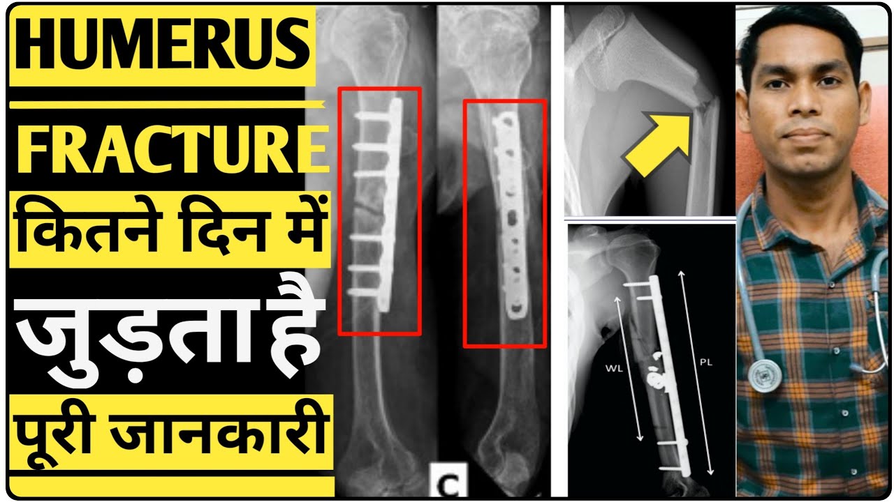 Humerus bone🦴 fracture healing timeline, Haddi (fracture) kitne din me ...