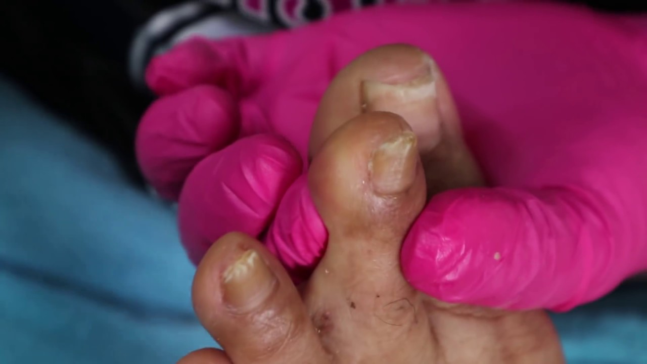 Ep_833 Foot nail removal 👣 เล็บบิดเป็นอย่างไง ? (This clip from ...