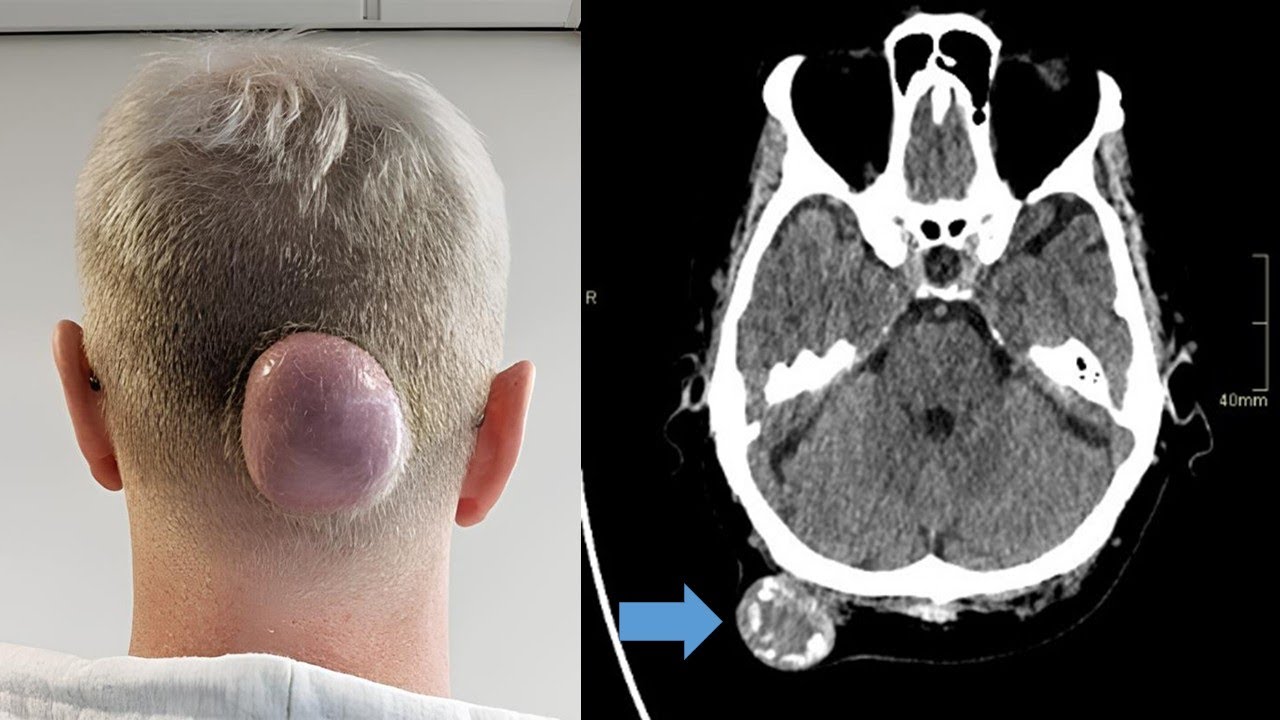 Calcified Sebaceous Cyst on Scalp | Infected Epidermal Inclusion Cyst ...