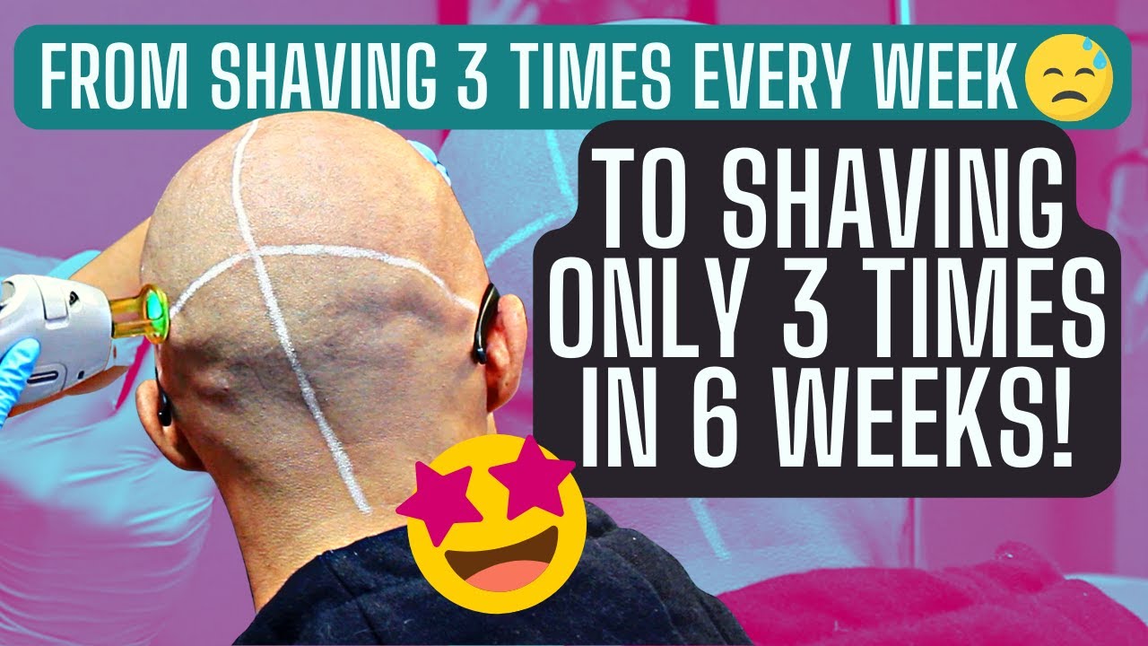 3RD SESSION OF LASER HAIR REMOVAL ON SCALP - YouTube