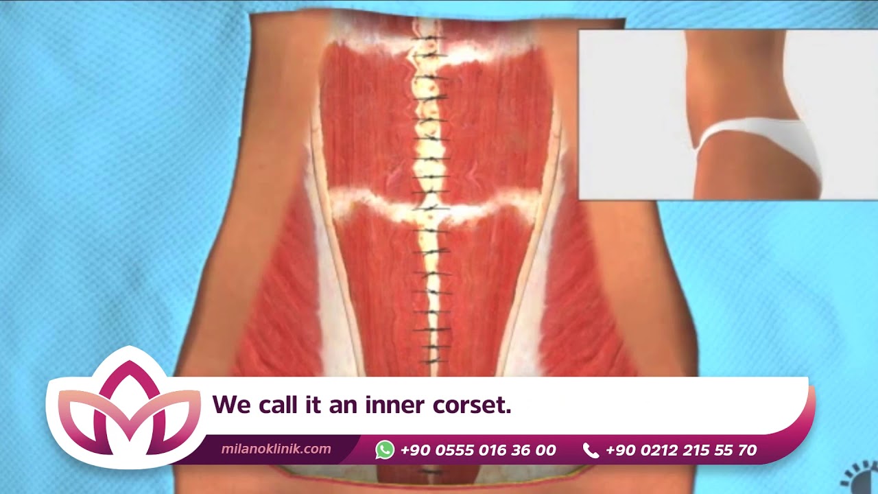 Mini TUMMY TUCK (Abdominoplasty) in Turkey | Milano Clinic - YouTube