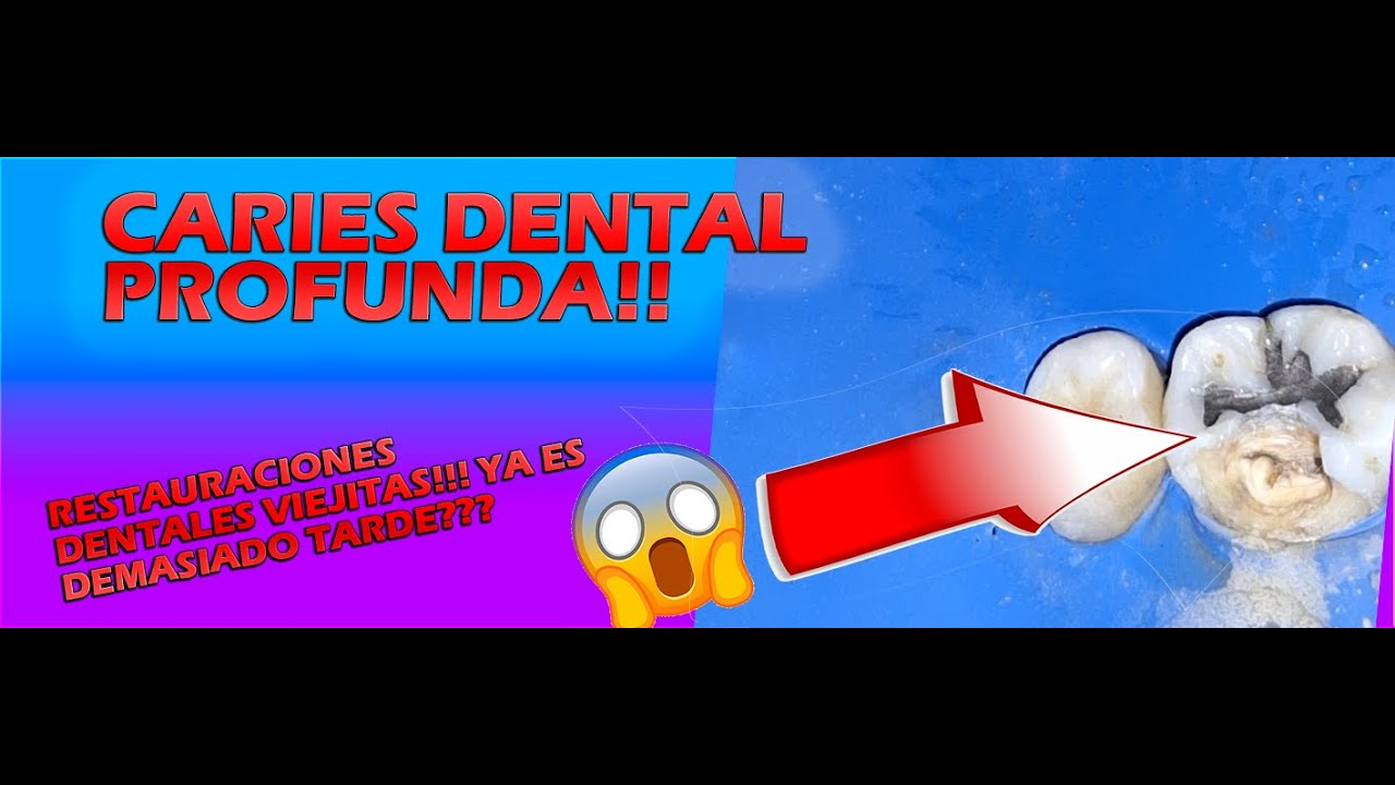 Caries Dental Profunda. ¿Cuando Reparar Mis Muelas? - YouTube