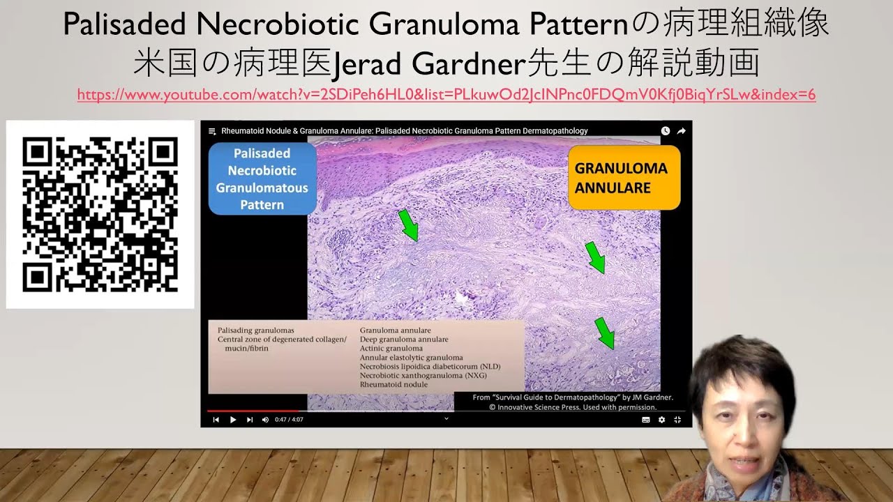 Palisaded necrobiotic granuloma patternの病理組織像の解説動画 - YouTube