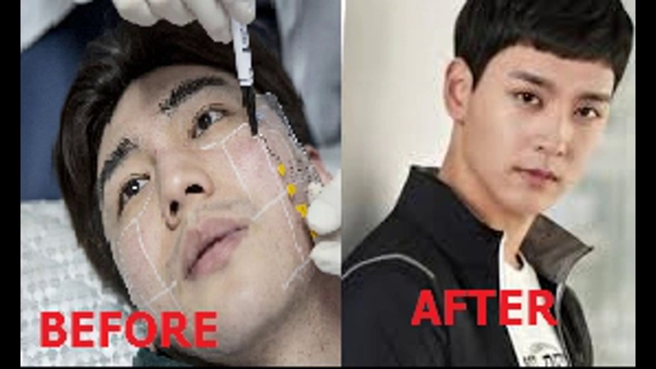 Cosmetic Surgery For Korean Male Actors Including Lee Min Ho Choi Tae Joon Lee Jong Suk And